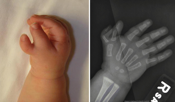 Hand and Wrist Deformities | SpringerLink