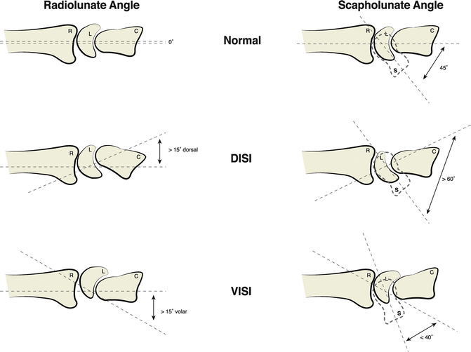 Carpal Instability | SpringerLink