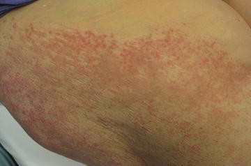 Skin Reactions to Immune Checkpoint Inhibitors | SpringerLink