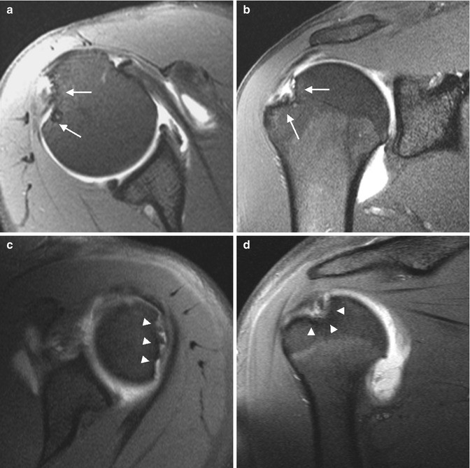 Shoulder Injury: MRI Pitfalls | SpringerLink