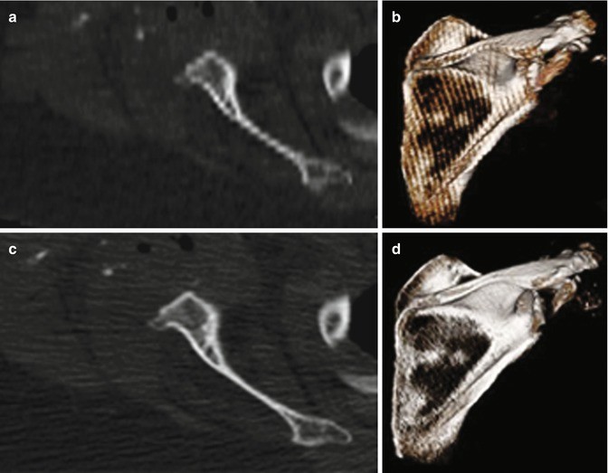 Computed Tomography Artifacts | SpringerLink