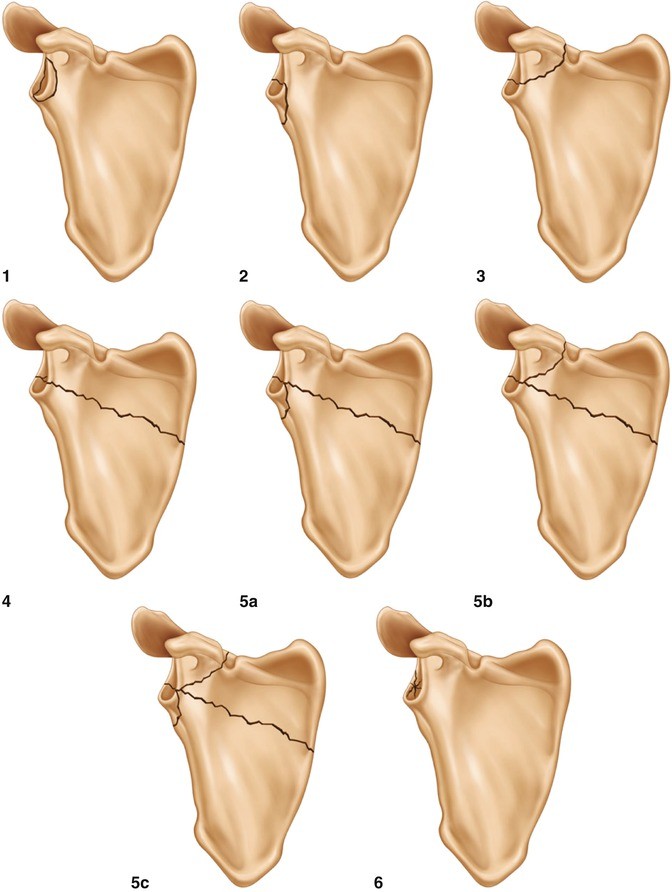 Scapula Fractures | SpringerLink