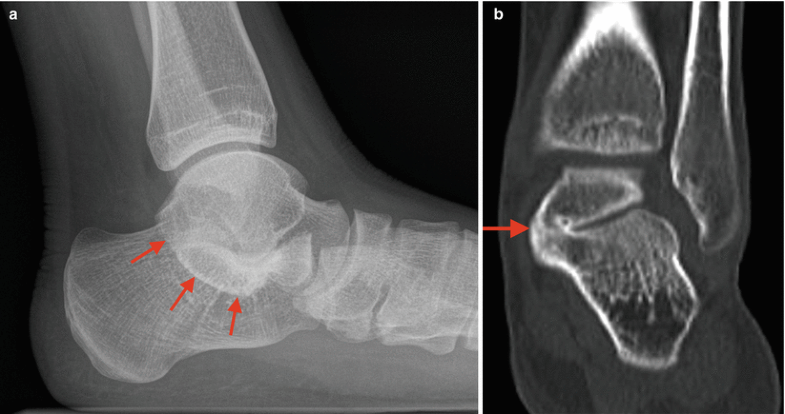 Imaging the Foot | SpringerLink