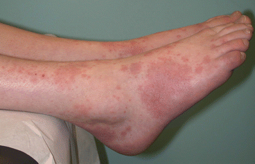 Viral Exanthems | SpringerLink