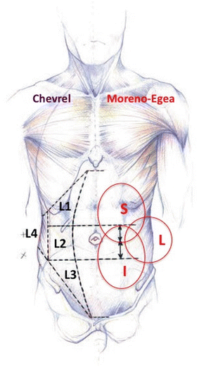 Management of Flank Complex Hernia | SpringerLink