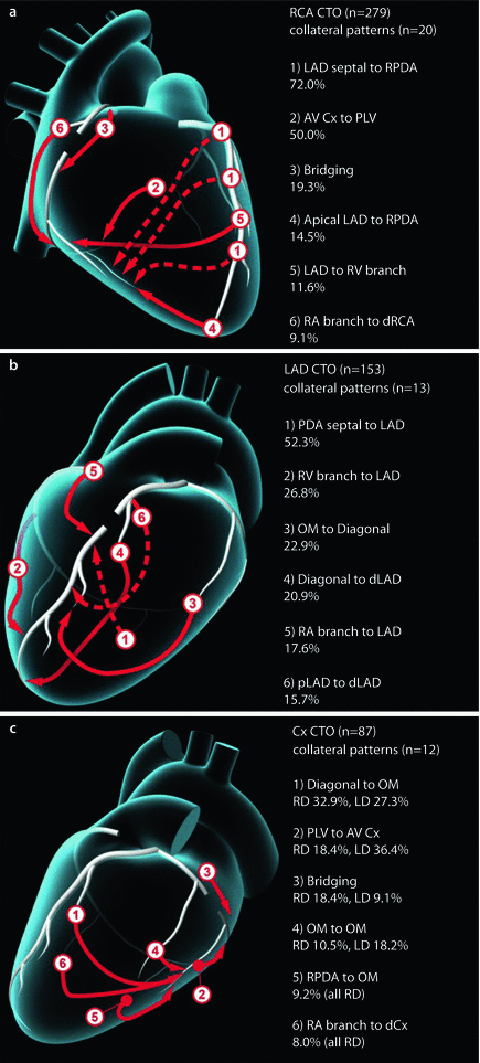 Coronary Collateral Circulation | SpringerLink