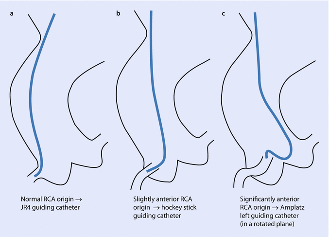 Guiding Catheters | SpringerLink