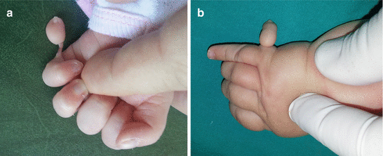 Polydactyly | SpringerLink