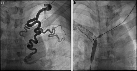 Exotic Arteriovenous Graft Creation | SpringerLink