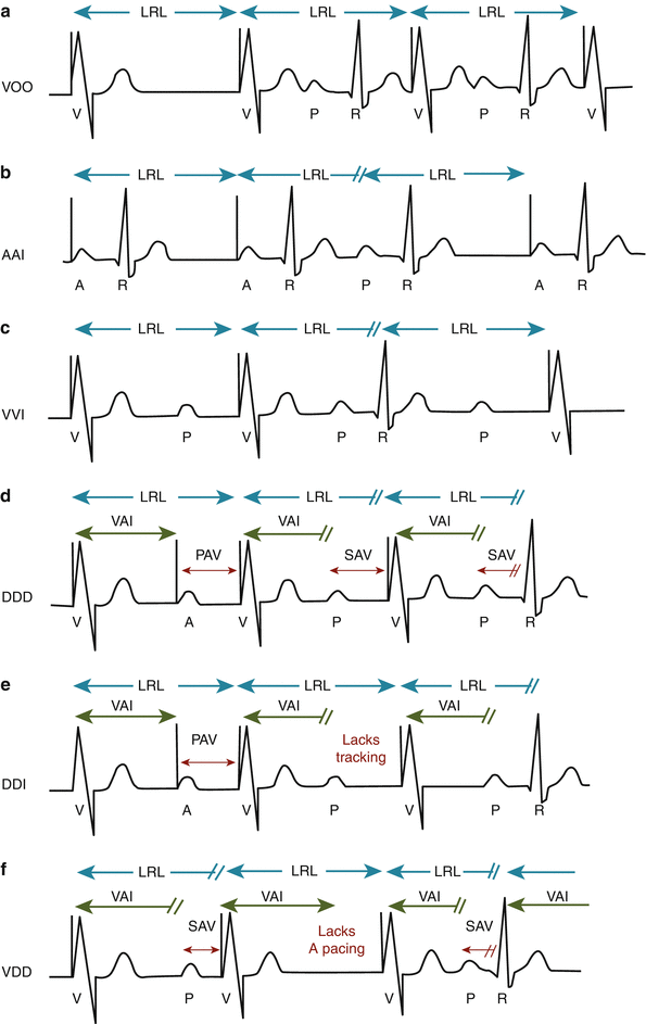 Cardiac Pacemakers | SpringerLink