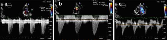 Tricuspid Valve Disease: Imaging Using Transthoracic Echocardiography ...