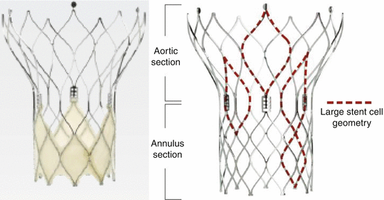 Transcatheter Aortic Valve Implantation: Abbott Portico | SpringerLink
