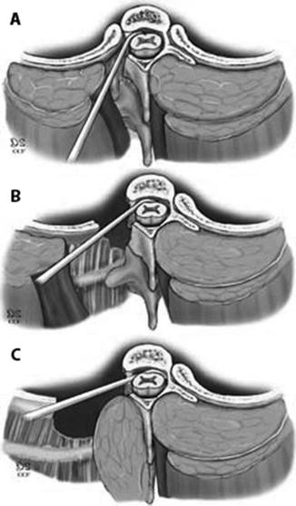 Thoracic Lateral Extracavitary Decompression and Fusion | SpringerLink