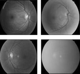 Classification of Cataract Fundus Image Based on Retinal Vascular ...