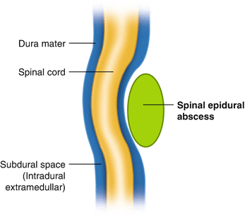 Spinal Epidural Abscesses | SpringerLink
