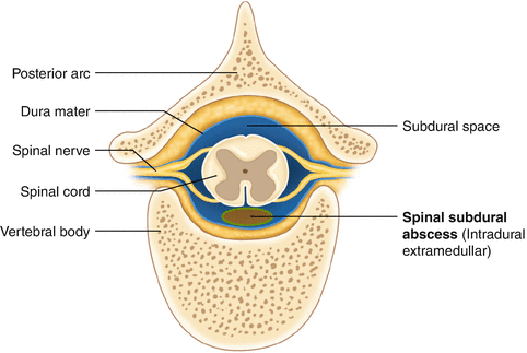 Spinal Subdural Abscesses | SpringerLink