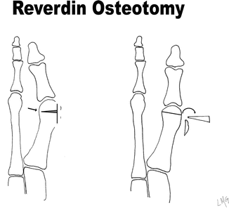 Distal Metatarsal Osteotomy and Capsular Balancing | SpringerLink