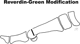 Distal Metatarsal Osteotomy and Capsular Balancing | SpringerLink