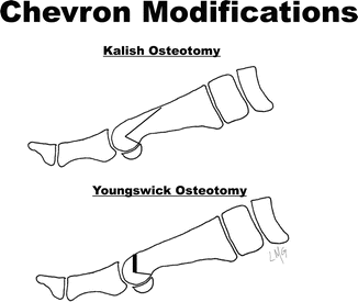 Distal Metatarsal Osteotomy and Capsular Balancing | Springer for ...