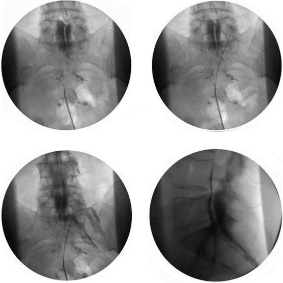 Percutaneous Adhesiolysis | SpringerLink