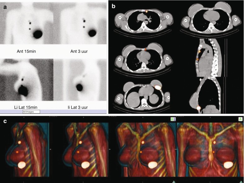 Lymphoscintigraphy and Sentinel Node Localization in Breast Cancer ...