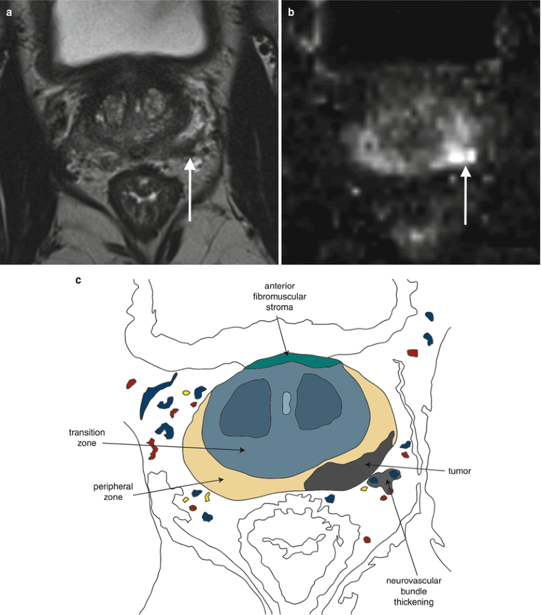Prostate Cancer and MRI: Local Staging | SpringerLink