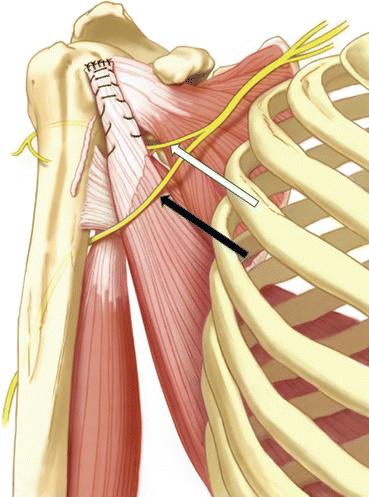 Transfer in Subscapularis Lesions: Open Surgical Technique | SpringerLink