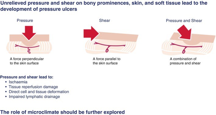 Pressure Ulcers | SpringerLink