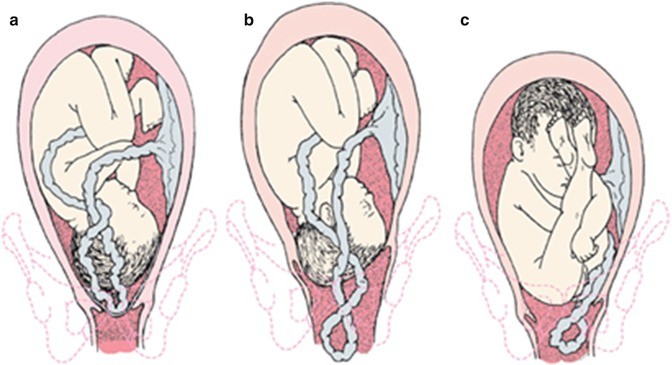 Umbilical Cord Prolapse | SpringerLink