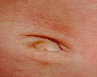 Umbilicus Types and Shapes | SpringerLink