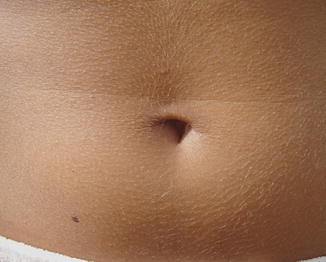 Umbilicus Types and Shapes | SpringerLink