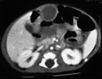 Omphalitis | SpringerLink