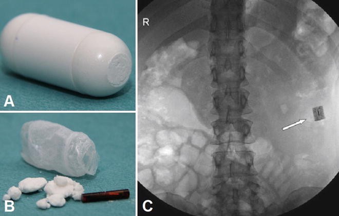 Capsule Endoscopy | SpringerLink