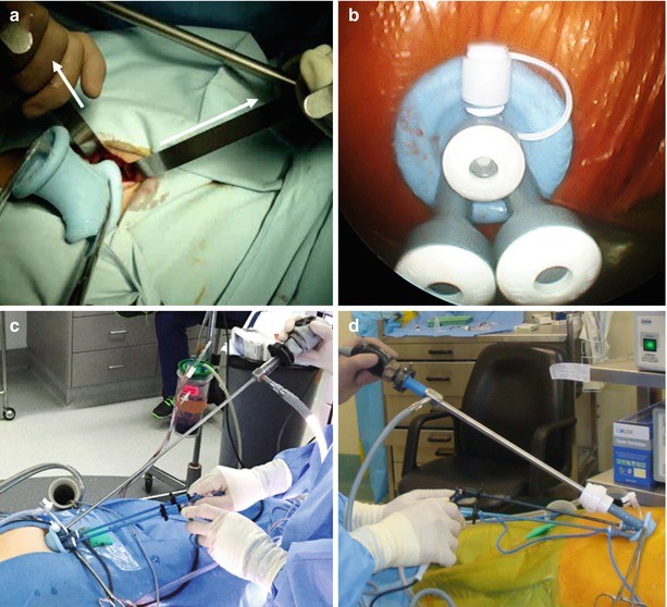 Single Incision Laparoscopic Inguinal Hernia Repair | SpringerLink