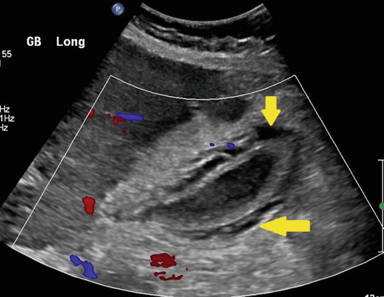 Acute Acalculous Cholecystitis | SpringerLink