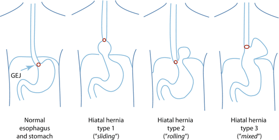 Utility of Endoscopy in the Diagnosis of Hiatus Hernia and Correlation ...