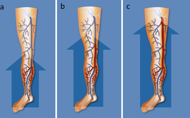 Cosmetic Approach to Varicose Veins: The ASVAL Technique | SpringerLink