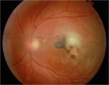 Differential Diagnosis of Endophthalmitis | SpringerLink