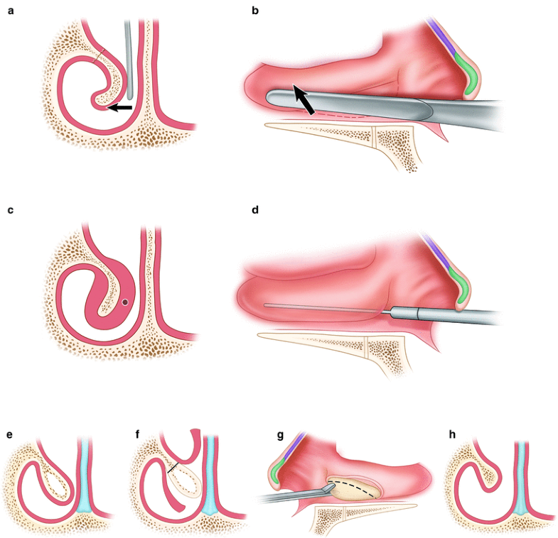 Septum, Turbinates, Valves | SpringerLink