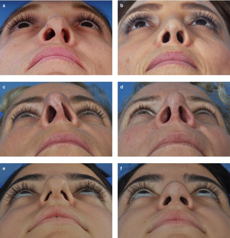 Septum, Turbinates, Valves | SpringerLink