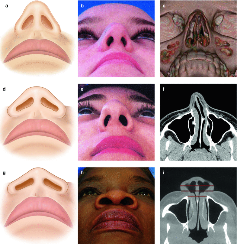 Nasal Base | SpringerLink