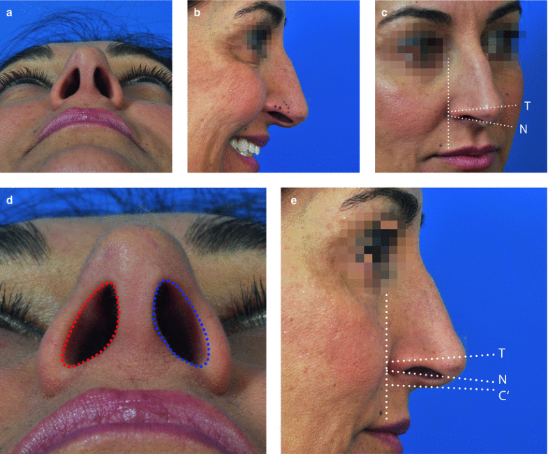 Nasal Base | SpringerLink