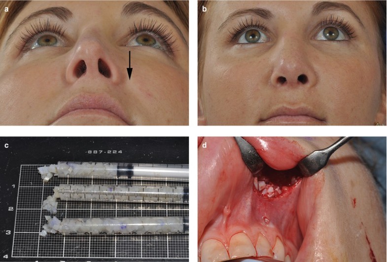 Nasal Base | SpringerLink