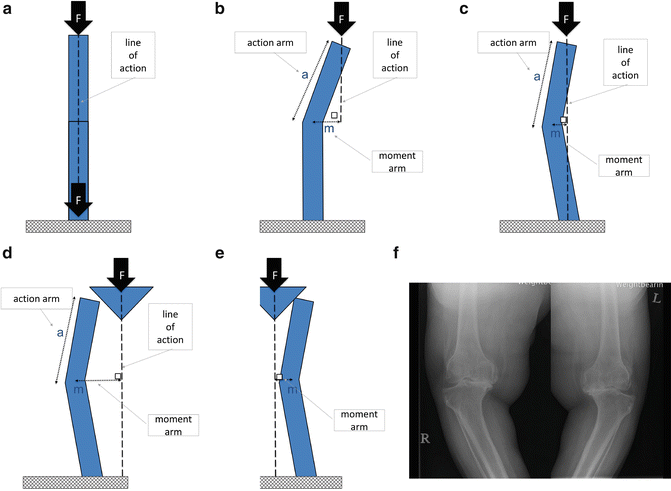 Restoration of Stability, Maintaining Joint Line, Gap Balancing, and ...