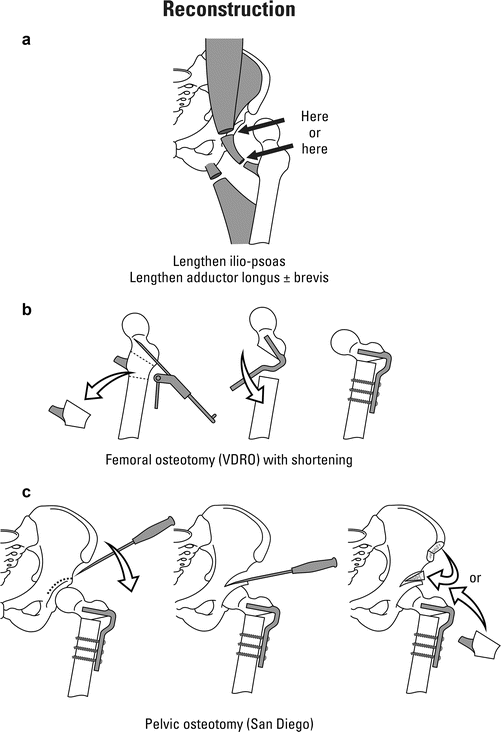 Integrated Management in Cerebral Palsy: Musculoskeletal Surgery and ...