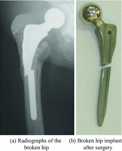 Metallic Biomaterials | SpringerLink