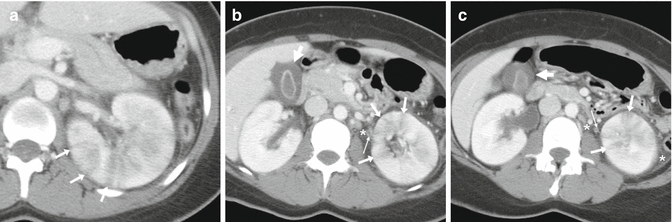 CT Imaging and Differential Diagnosis of Acute Pyelonephritis ...