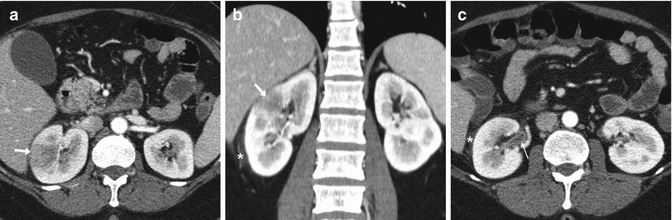 CT Imaging and Differential Diagnosis of Acute Pyelonephritis ...