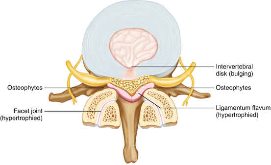 Degenerative Lumbar Spinal Stenosis and Spondylolisthesis | SpringerLink