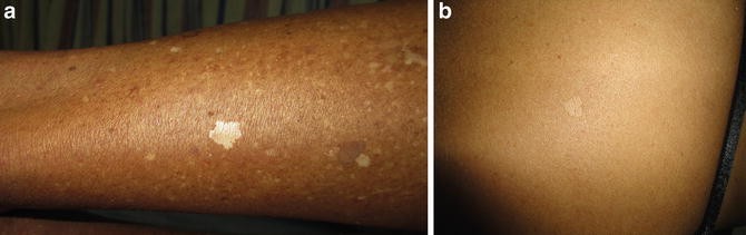 Guttate Leukoderma | SpringerLink